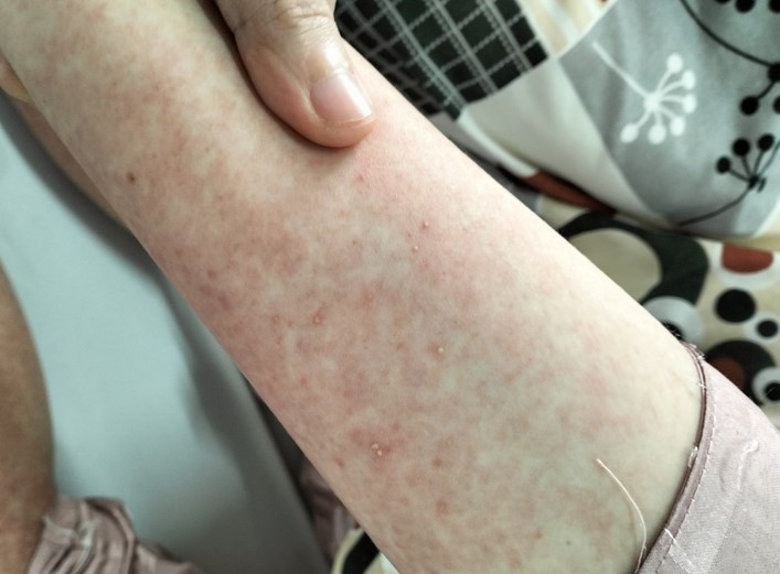 Nổi mụn mủ toàn thân do căn bệnh 100.000 người mới có 1 người mắc | Báo ...